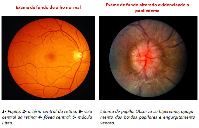 fundo de olho